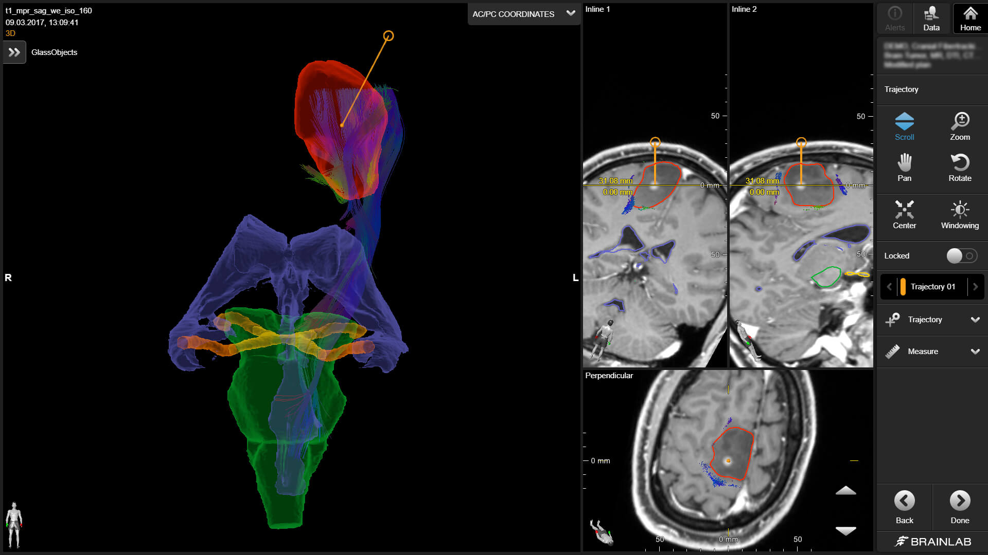 Cranial Planning with Elements: Software for Neurosurgery | Brainlab